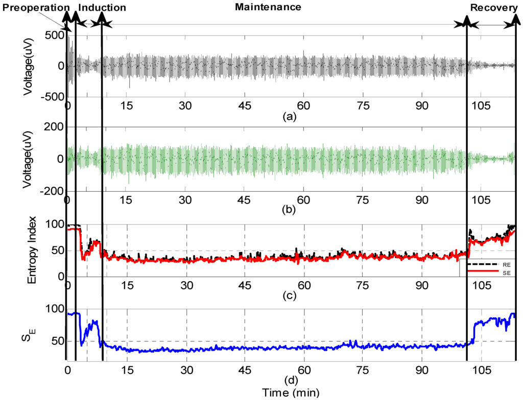 Adaptive Computation of Multiscale Entropy and Its Application in EEG Signals for Monitoring ...