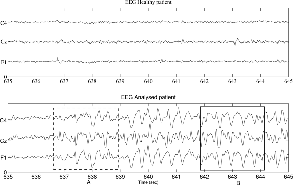 Permutation Entropy Applied to the Characterization of the Clinical Evolution of Epileptic ...