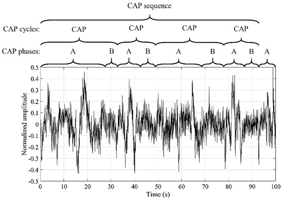 A Portable Wireless Device for Cyclic Alternating Pattern Estimation from an EEG Monopolar ...