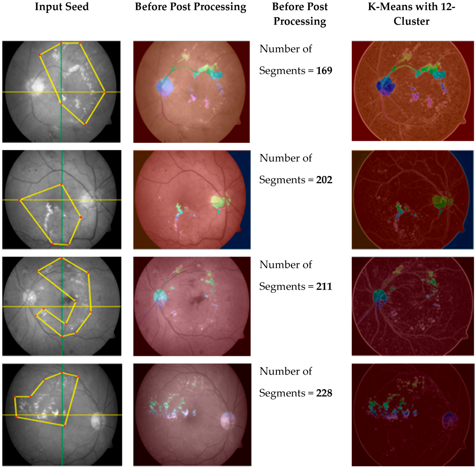 Machine Learning Based Automated Segmentation and Hybrid Feature ...