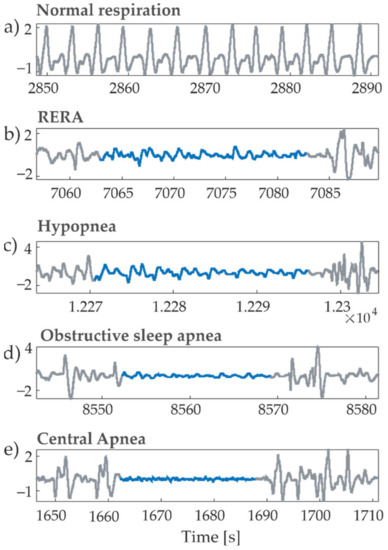 Entropy | Free Full-Text | Assessment of Cardiorespiratory Interactions ...