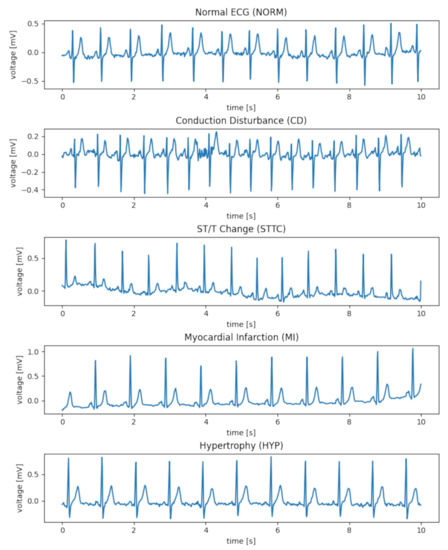 ECG Signal Classification Using Deep Learning Techniques Based on the ...