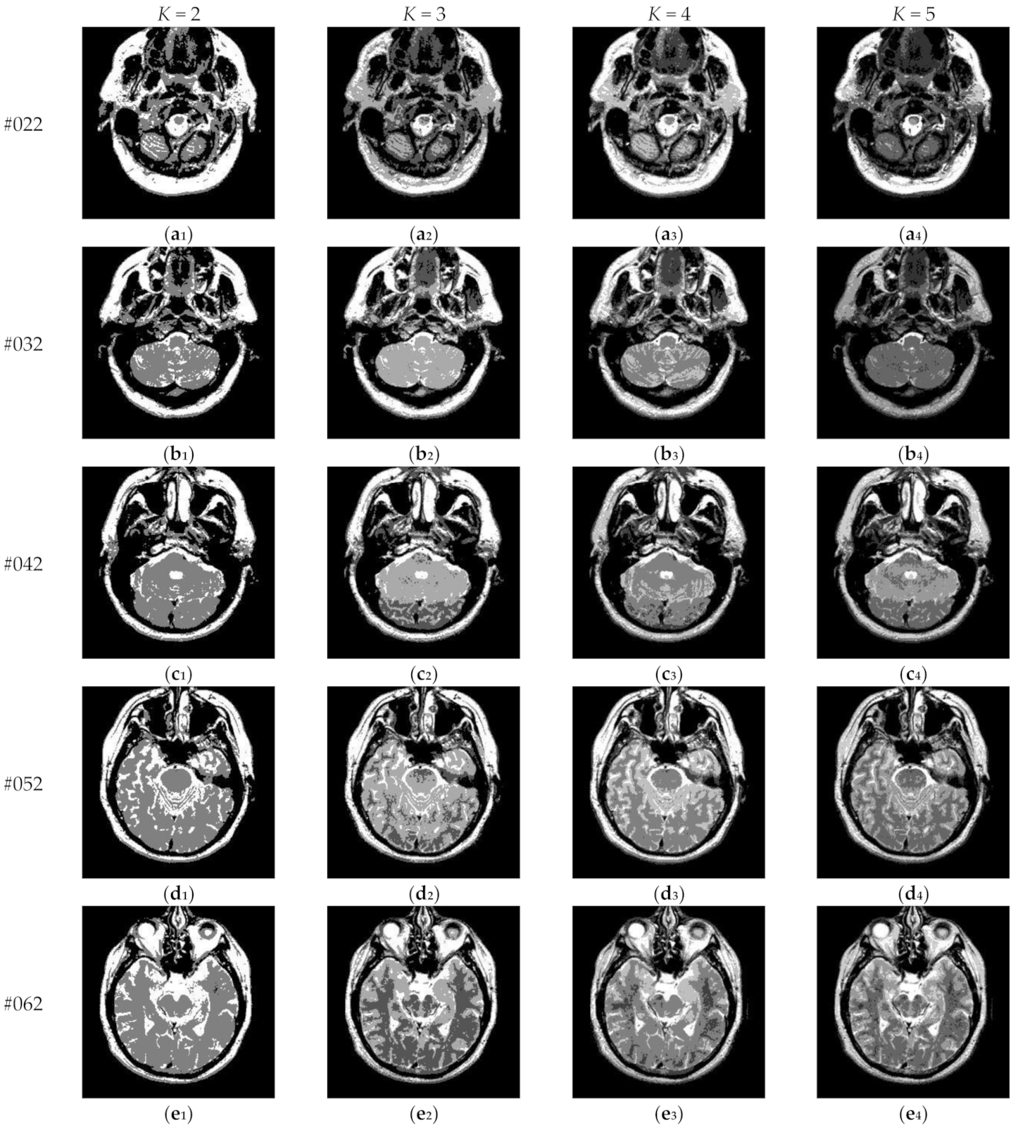 An Interval Iteration Based Multilevel Thresholding Algorithm for Brain MR Image Segmentation