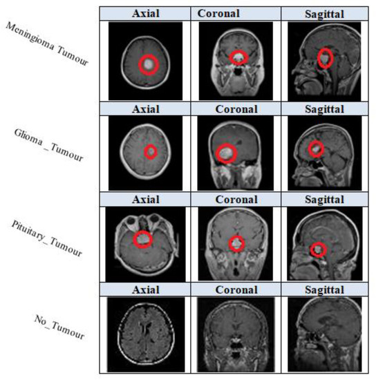 A Hybrid Deep Learning Model for Brain Tumour Classification