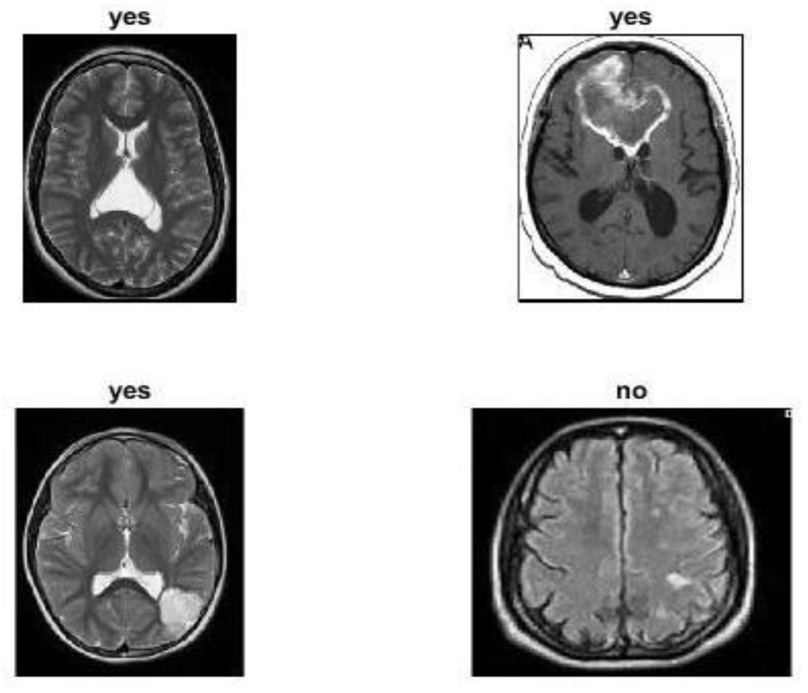 A Hybrid Deep Learning Model for Brain Tumour Classification