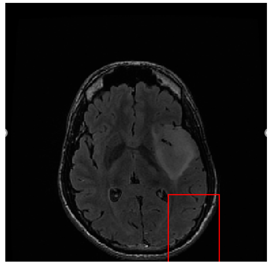 Entropy | Free Full-Text | Brain Tumor Segmentation Based on Bendlet Transform and Improved Chan ...