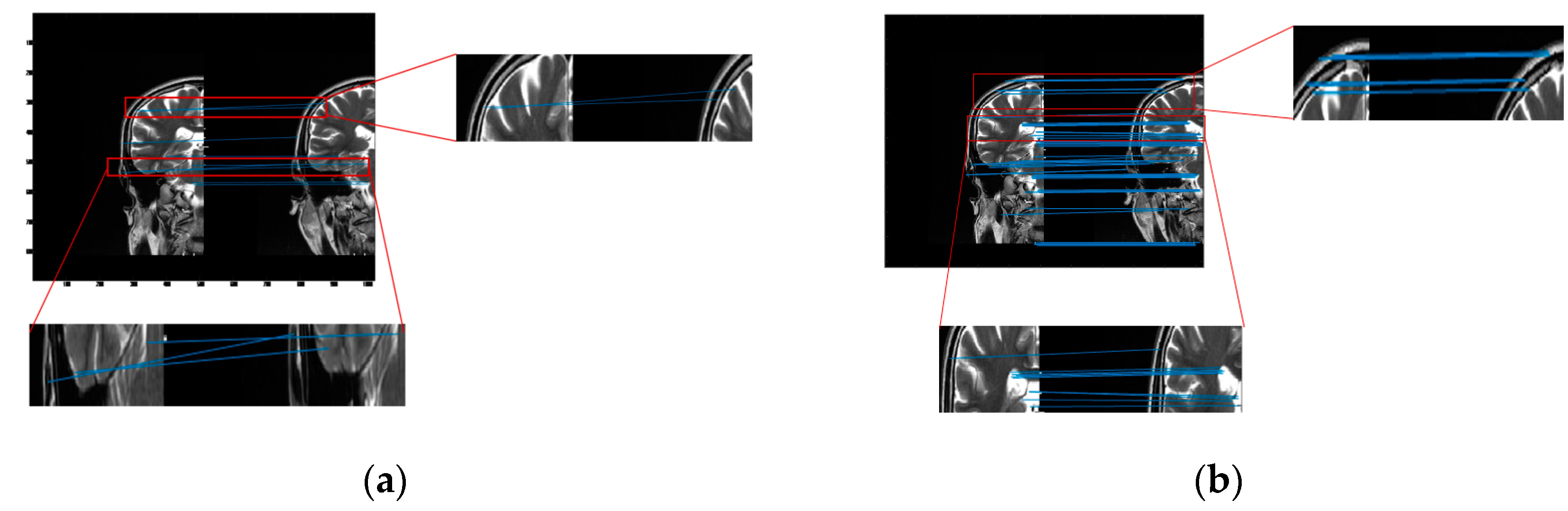 Entropy | Free Full-Text | Brain Tumor Segmentation Based on Bendlet Transform and Improved Chan ...