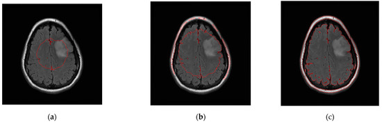 Brain Tumor Segmentation Based on Bendlet Transform and Improved Chan ...