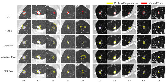 Improved Complementary Pulmonary Nodule Segmentation Model Based on ...