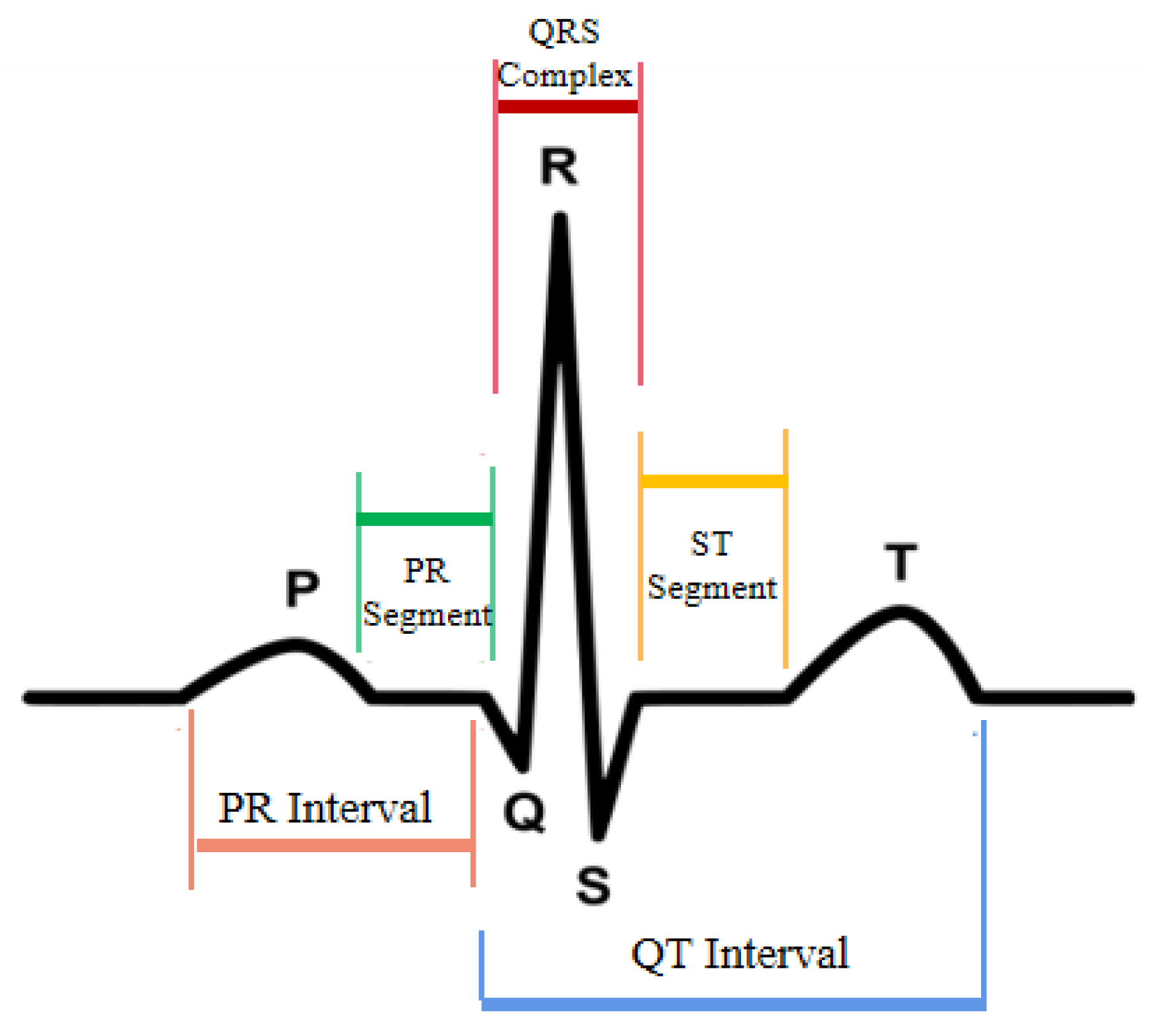 A Novel ECG Signal Denoising Algorithm Based on Sparrow Search Algorithm for Optimal Variational ...