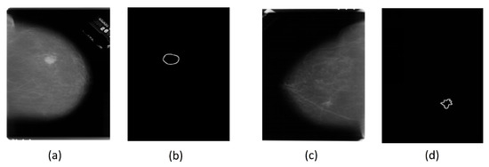 Benign and Malignant Breast Tumor Classification in Ultrasound and ...