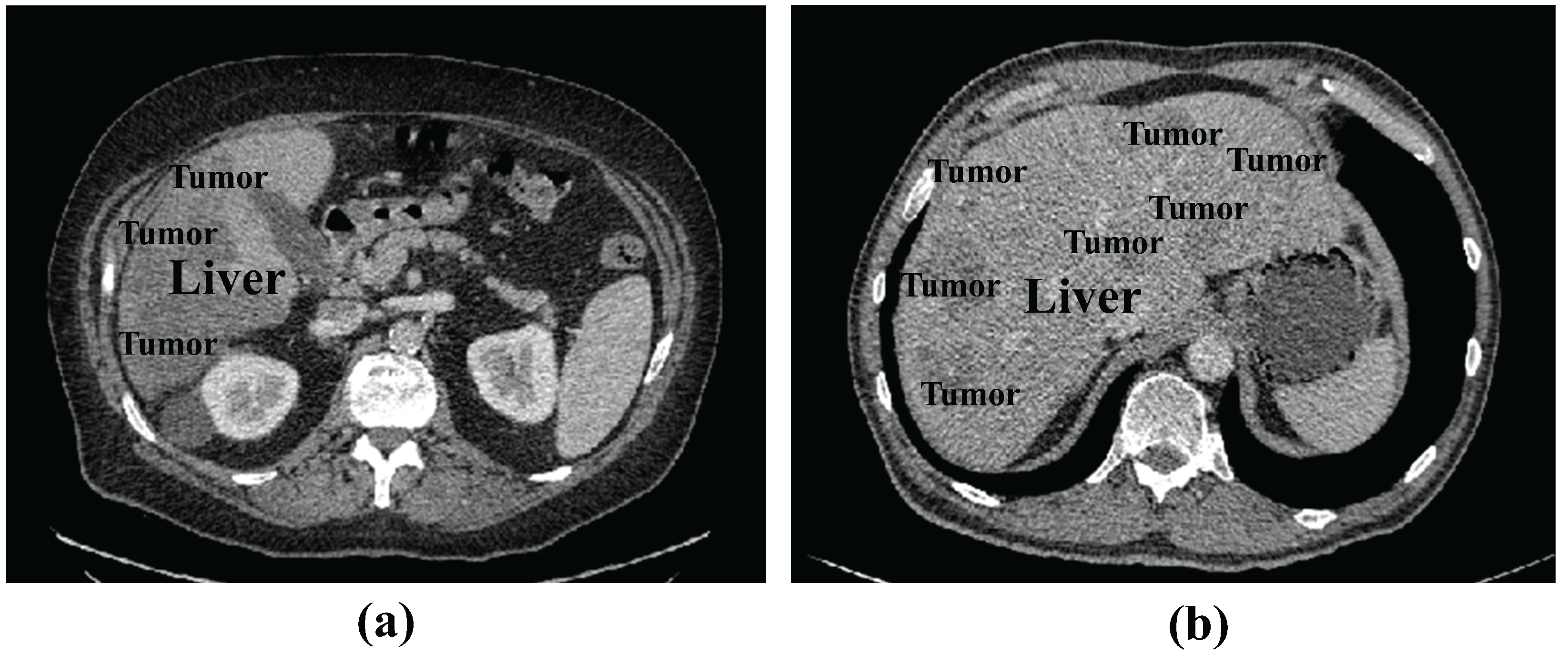 RIS-UNet: A Multi-Level Hierarchical Framework for Liver Tumor Segmentation in CT Images