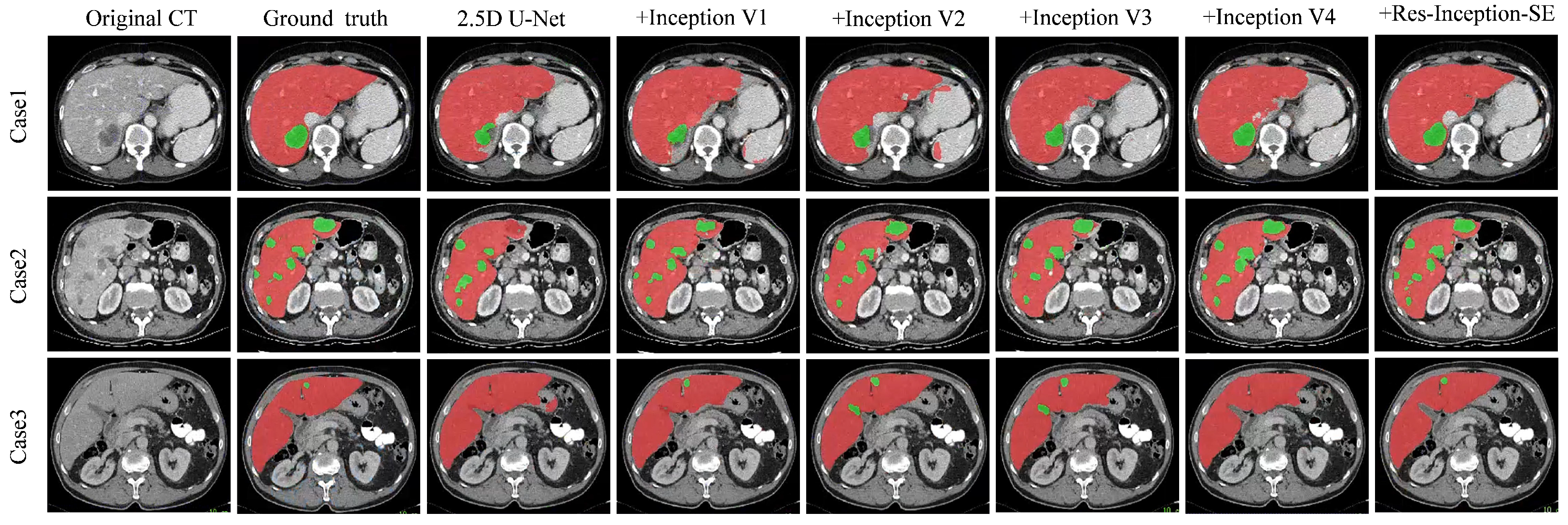 RIS-UNet: A Multi-Level Hierarchical Framework for Liver Tumor Segmentation in CT Images