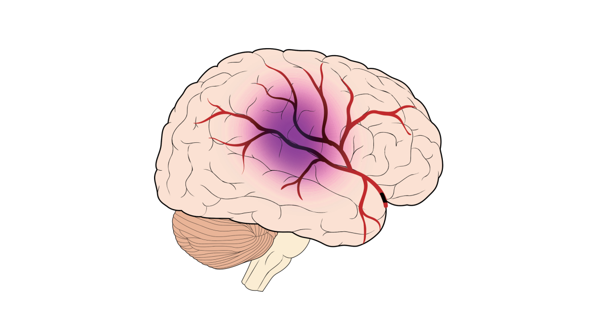 Ischemic Stroke Animation