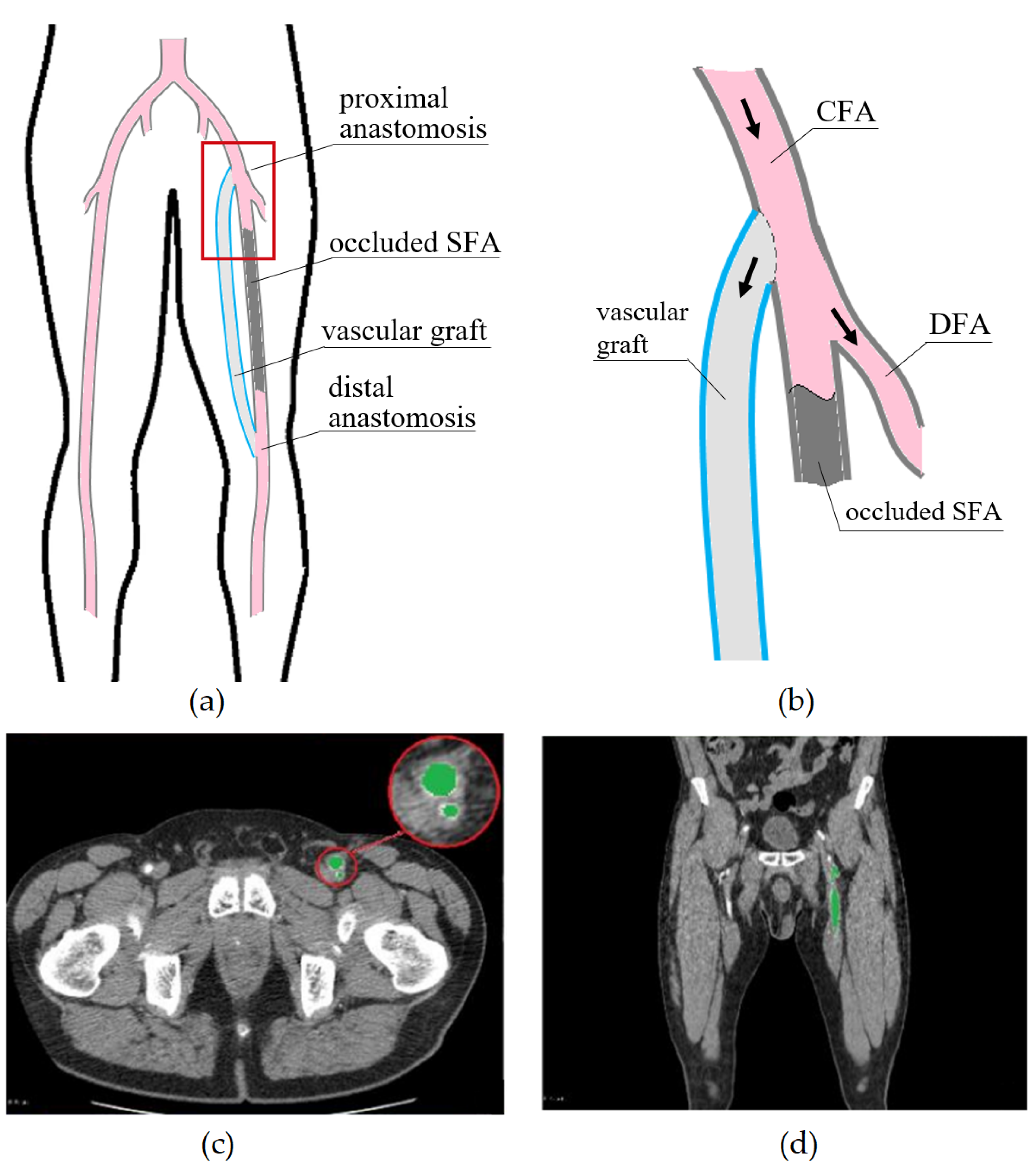 Fluids | Free Full-Text | Experience of Patient-Specific CFD Simulation ... Fluids | Free Full-Text | Experience of Patient-Specific CFD Simulation ...