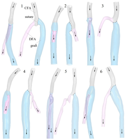 Experience of Patient-Specific CFD Simulation of Blood Flow in Proximal ...