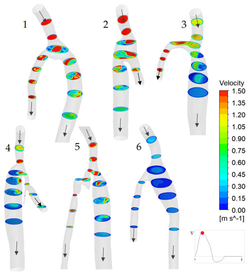 Experience of Patient-Specific CFD Simulation of Blood Flow in Proximal ...