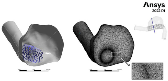 Hemodynamic Investigation of the Flow Diverter Treatment of ...