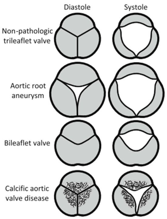 Fluid–Structure Interaction Aortic Valve Surgery Simulation: A Review