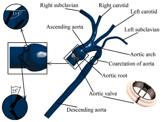 Fluid–Structure Interaction Aortic Valve Surgery Simulation: A Review