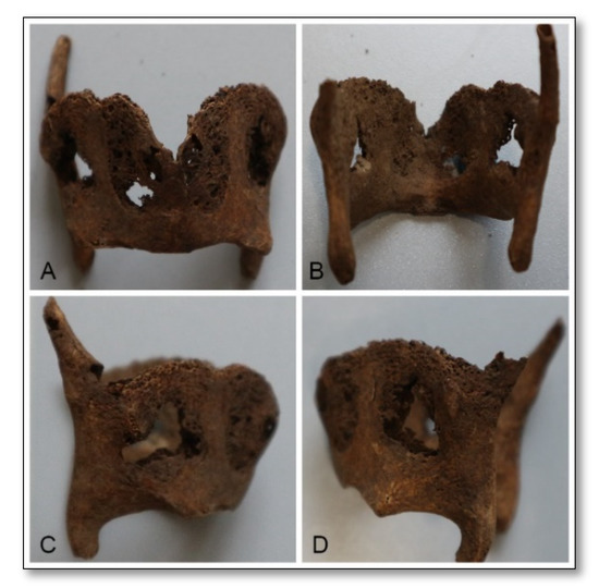 Fully Ossified Thyroid Cartilage Found among the Skeletal Remains of A ...
