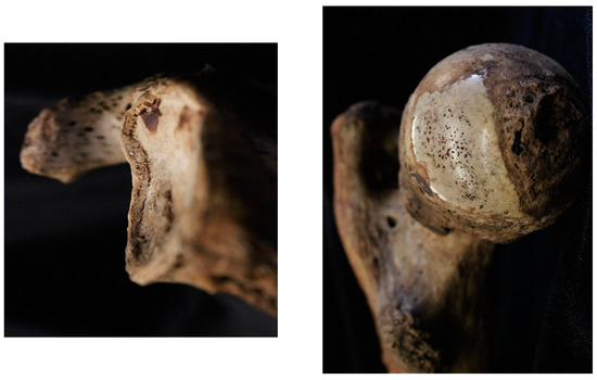 Utility of Osteoarthritis as an Indicator of Age in Human Skeletal ...