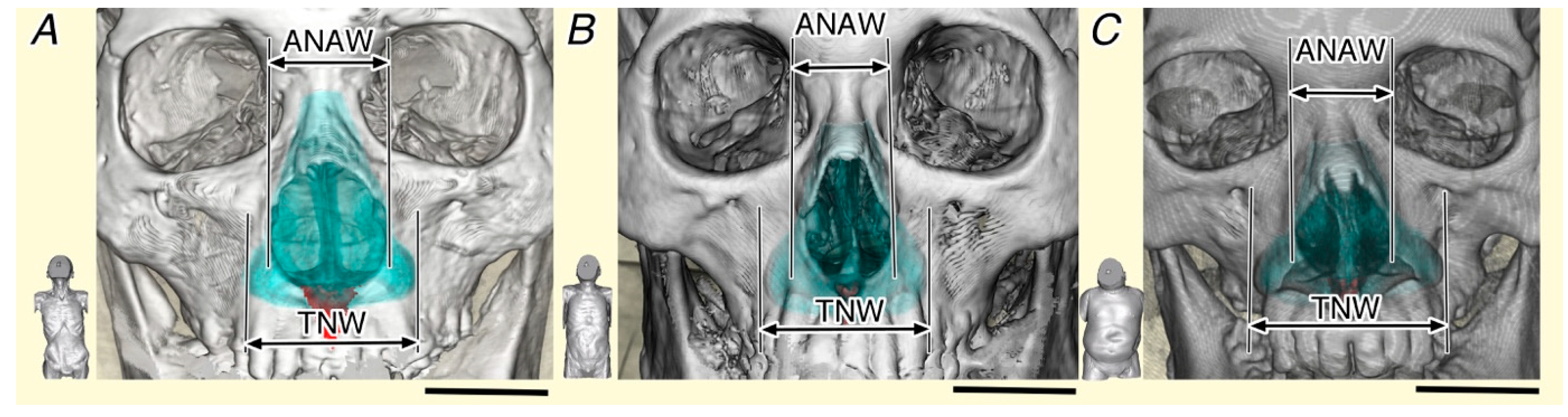 Simplified Formula for Estimating Nasal Dimensions for 3-Dimensional ...