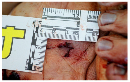 Gunshot Defense Wounds: Three Case Reports and a Literature Review