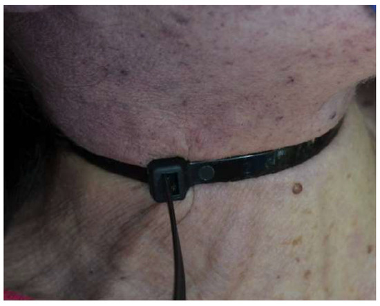 Strangulation Using Cable Ties and a Suicidal Manner of Death: A Case ...