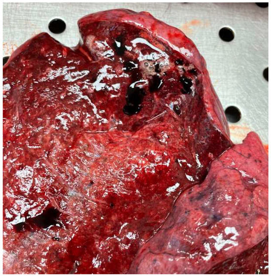 Strangulation Using Cable Ties and a Suicidal Manner of Death: A Case ...