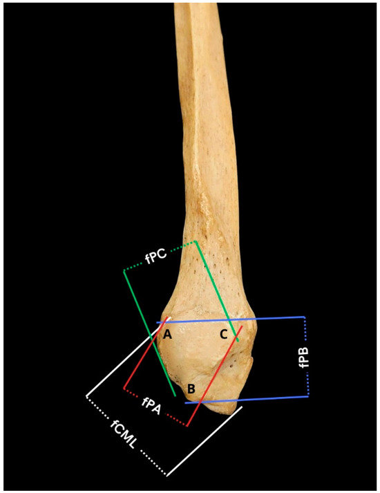 Sex Estimation from the Fibula and Tibia: A Study in Three Portuguese ...