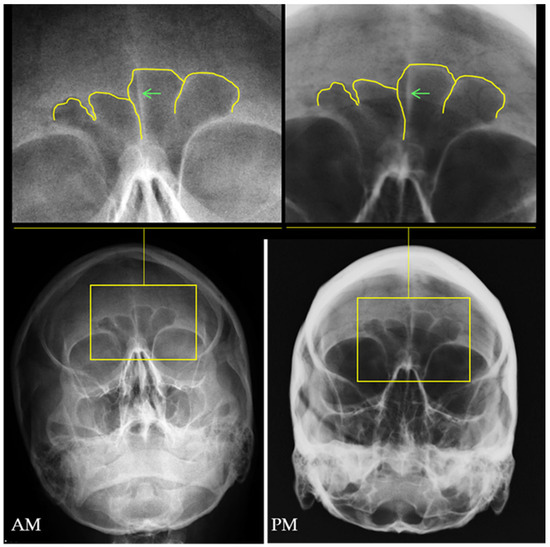 The Use of Paranasal Sinuses in Human Identification: Useful Concepts ...