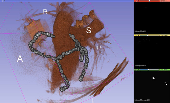 Coronary Centerline Extraction from CCTA Using 3D-UNet