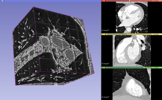 Coronary Centerline Extraction from CCTA Using 3D-UNet