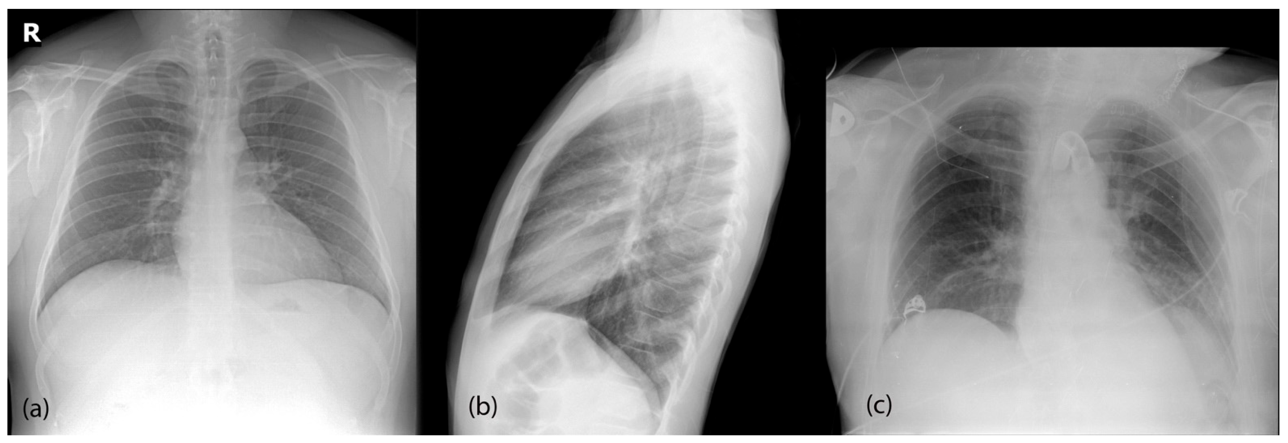 Towards Automatic Detection of Pneumothorax in Emergency Care with Deep Learning Using Multi ...