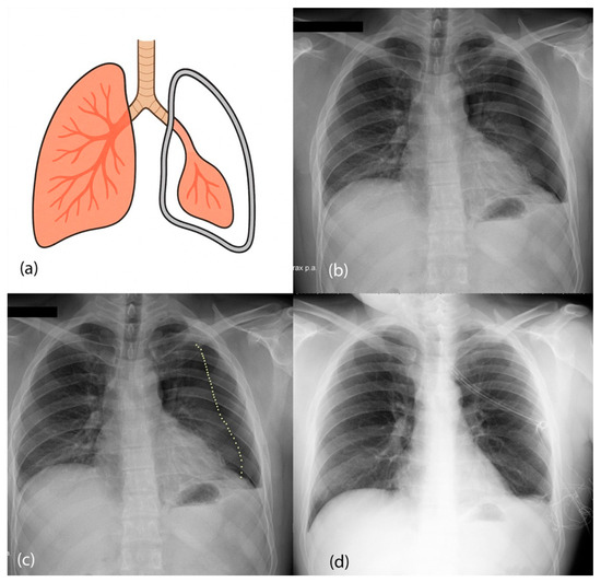 Hydropneumothorax X Ray Features
