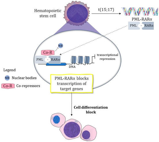 Acute Promyelocytic Leukemia (APL): A Review of the Classic and ...