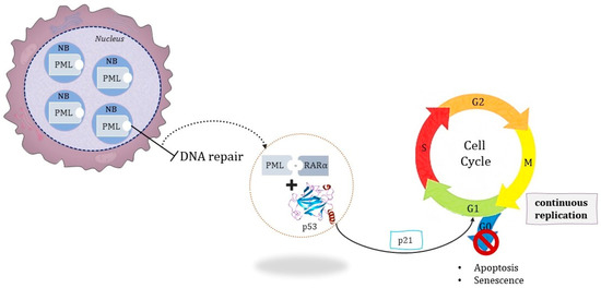 Acute Promyelocytic Leukemia (APL): A Review of the Classic and ...