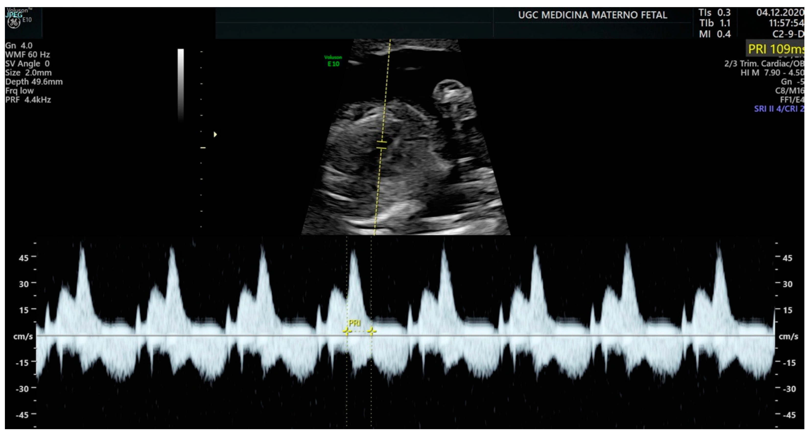 Transplacental Treatment of Fetal Tachyarrhythmia: Current Trends and ...