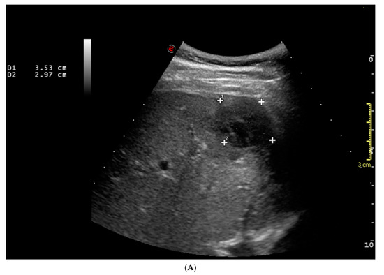 Contrast-Enhanced Ultrasound LI-RADS LR-5 in Hepatic Tuberculosis: Case ...