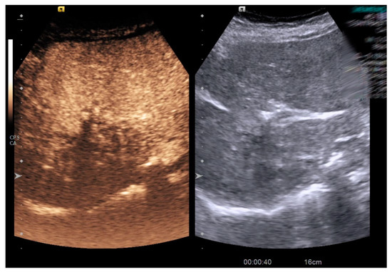 Ultrasound-Guided Percutaneous Drainage of Abdominal Collections—An ...