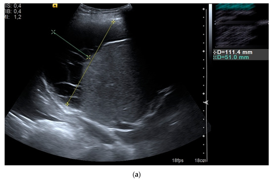 Ultrasound-Guided Percutaneous Drainage of Abdominal Collections—An ...