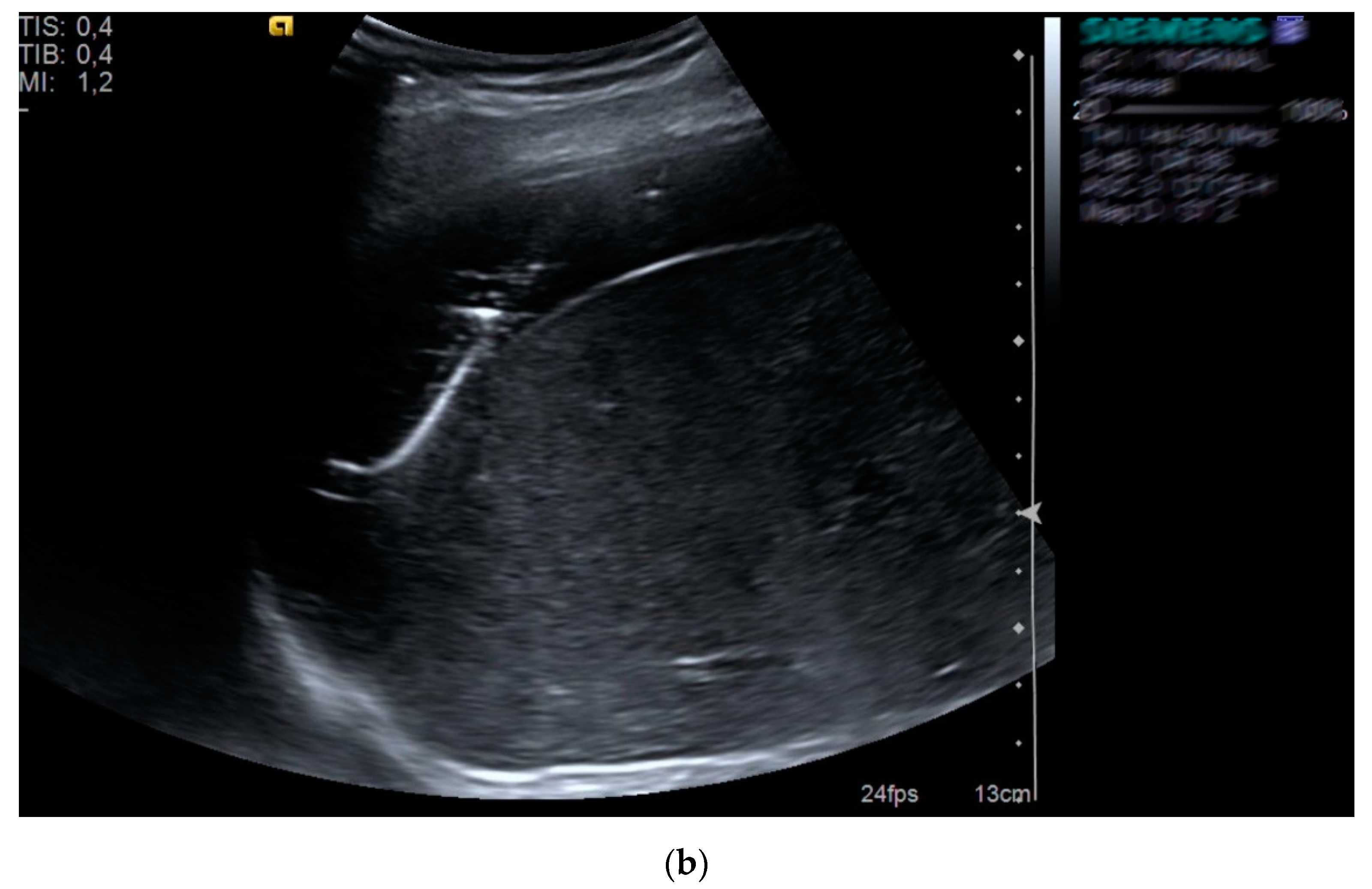 Ultrasound-Guided Percutaneous Drainage of Abdominal Collections—An ...