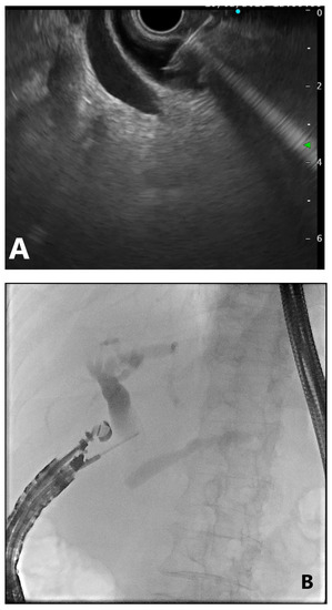 Troubleshooting Difficult Bile Duct Access: Advanced ERCP Cannulation ...