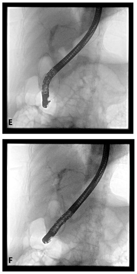 Troubleshooting Difficult Bile Duct Access: Advanced ERCP Cannulation ...