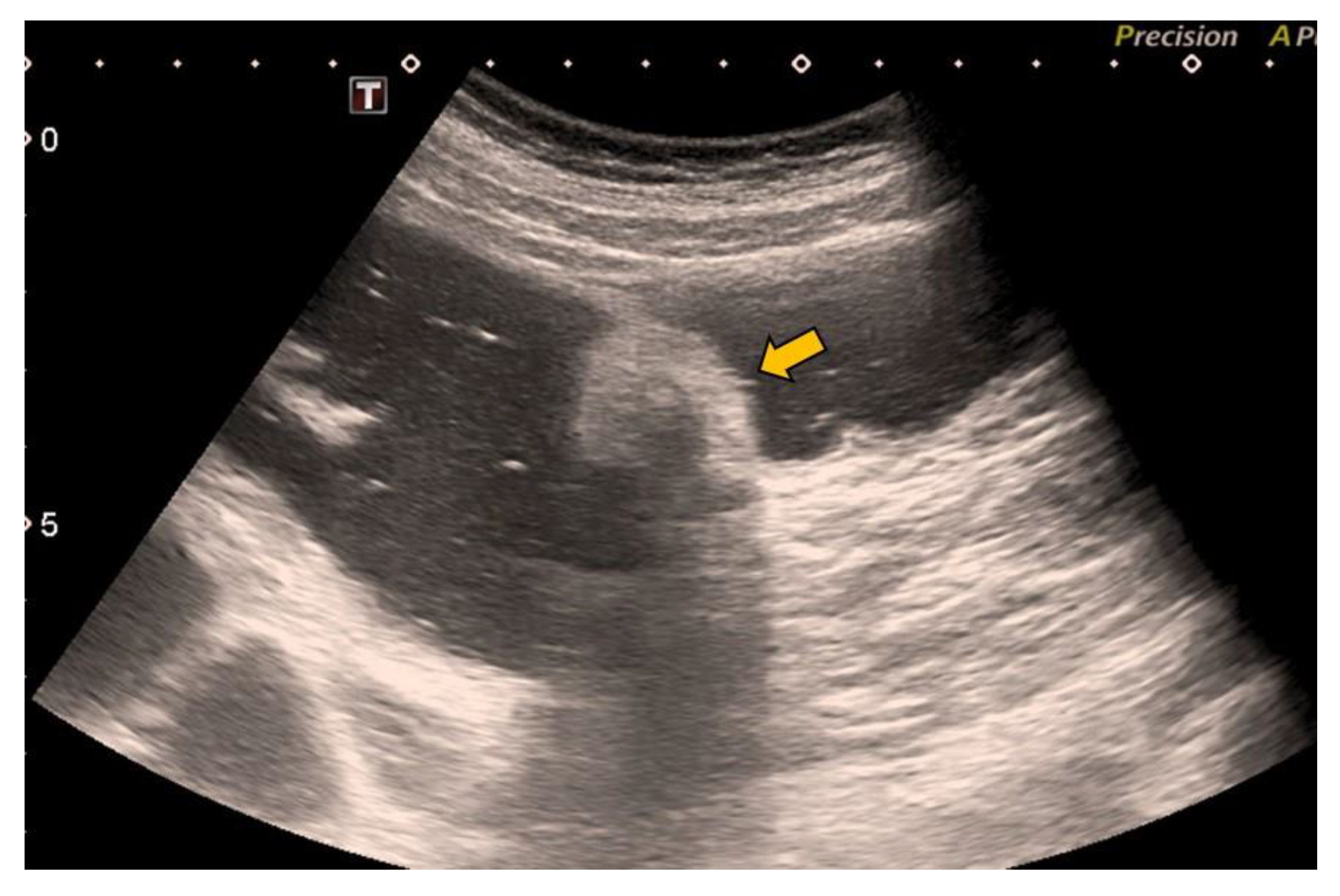 Gastroenterology Insights | Free Full-Text | Hydrocolonic Sonography ...