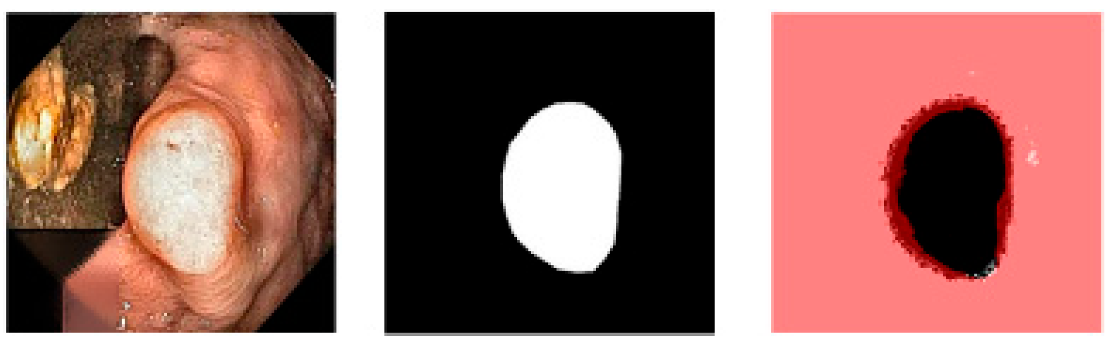 UPolySeg: A U-Net-Based Polyp Segmentation Network Using Colonoscopy Images