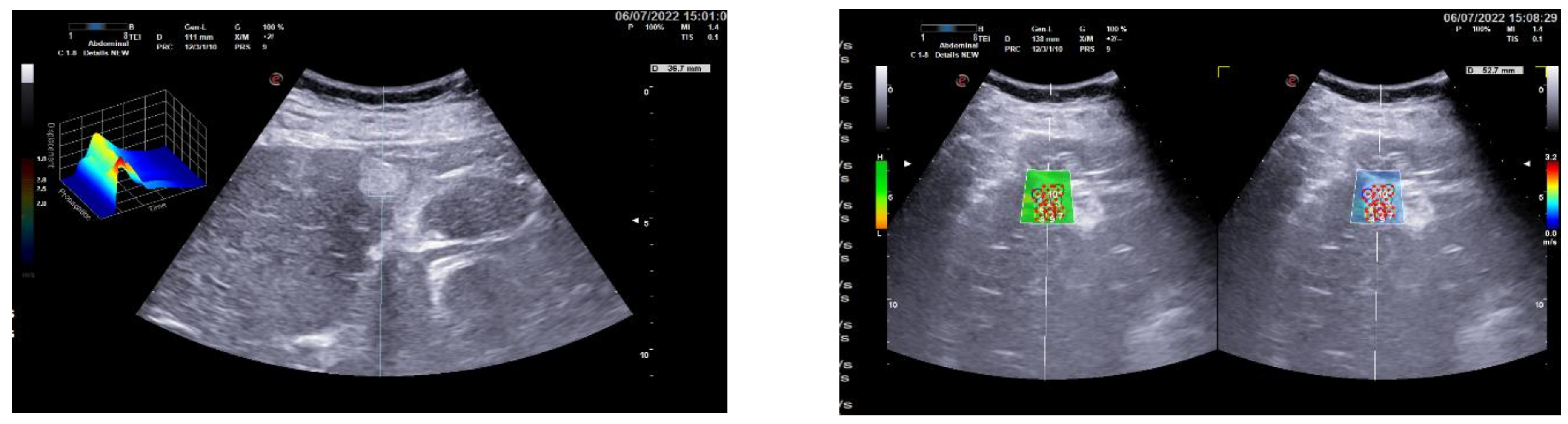 Gastroenterology Insights | Free Full-Text | Point Shear Wave ...