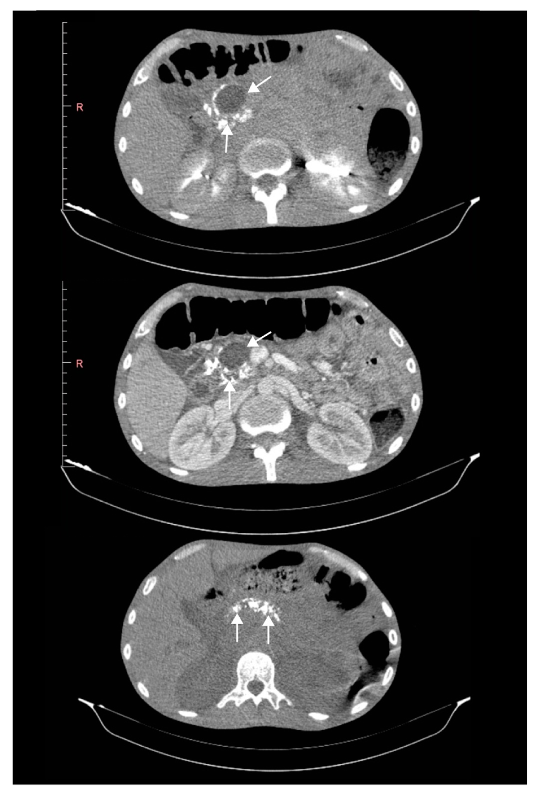 Gastroenterology Insights | Free Full-Text | Chronic Calcifying ...