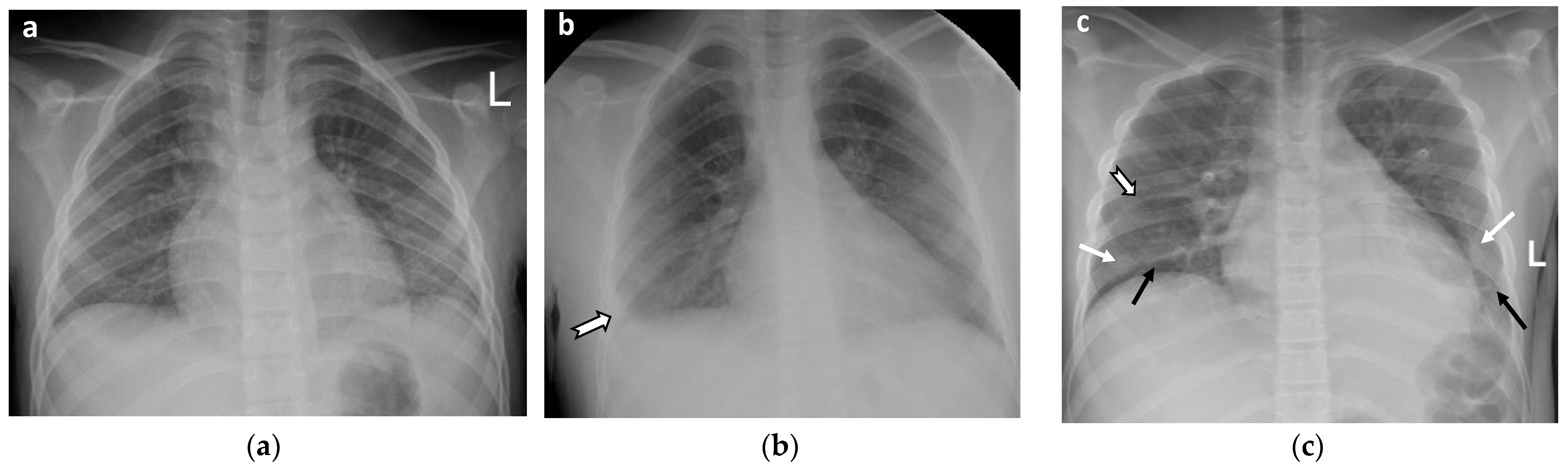 Abdominal and Thoracic Imaging Features in Children with MIS-C